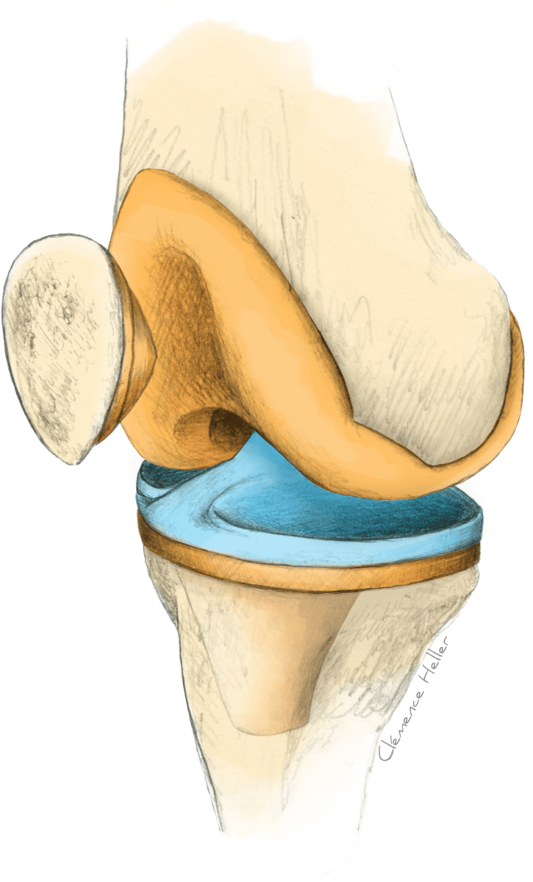 Prothèse de genou : causes, symptômes & traitements | Vivalto Santé